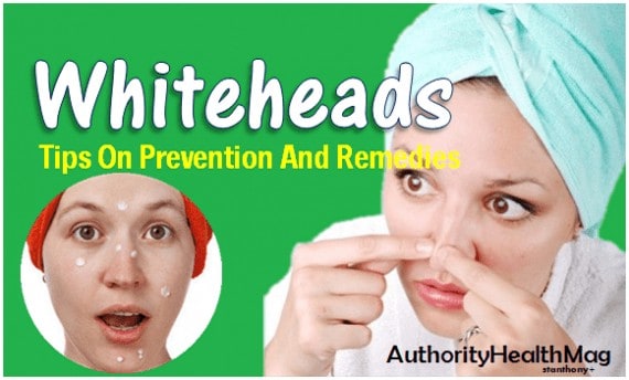 How To Get Rid Of Whiteheads From Face And Nose?