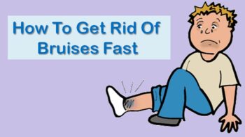 How To Get Rid Of Bruises Fast: 12 Simple Remedies