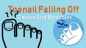 Why Are My Toenails Falling Off: Causes, Care, Prevention