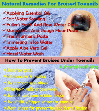 Bruised Toenail And Bruise Under Toenail - Treatments And Care