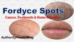 How To Get Rid Of Fordyce Spots | Clear Off Fordyce Spots Lips