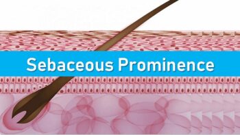Sebaceous Prominence | Removal, Treatment, Cream