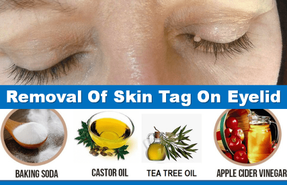 Tips On Removal Of Skin Tag On Eyelid – Home Remedies