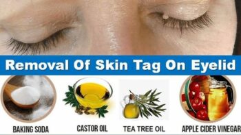How to Remove Skin Tag on Eyelid?