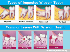 Cost of Removing Wisdom Teeth – Tooth Impaction, Surgery, Insurance