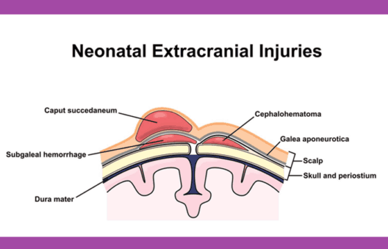 Cephalohematoma : Causes, Symptoms, Treatment, Complications